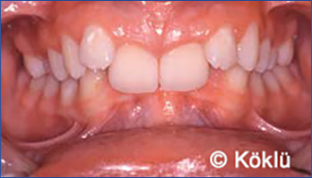 Kieferfehlstellungen | Kreuzbiss, Progenie, Rückbiss, Scheren-Tief ...